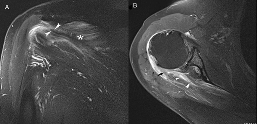 Skeletal Muscle Disease: Imaging Findings Simplified | American ...